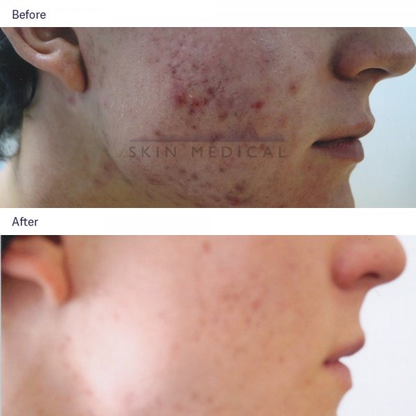 CO2 Laser Before and After Photo Gallery | Skin Medical