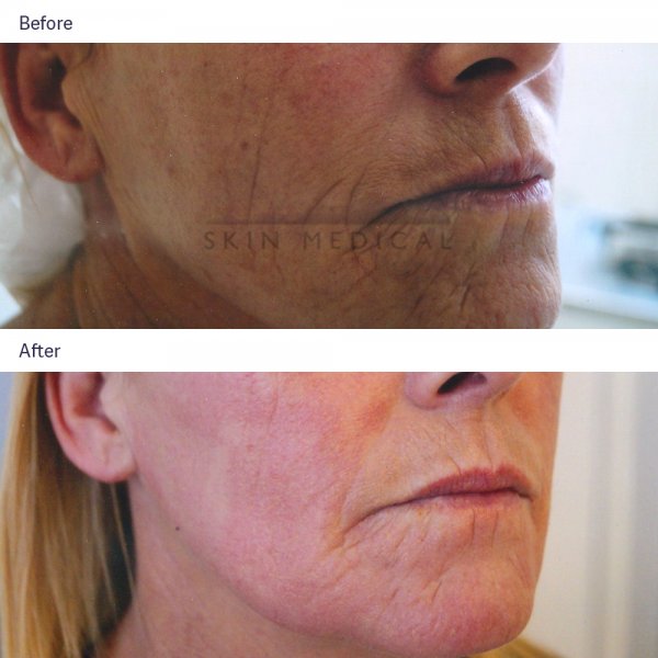 CO2 Laser Before and After Photo Gallery | Skin Medical